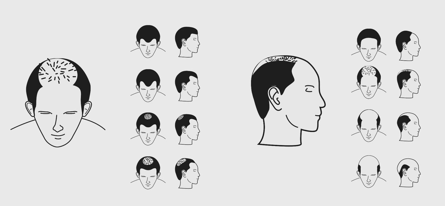 A Closer Look at Androgenic Alopecia (Male Pattern Baldness): From Ear ...